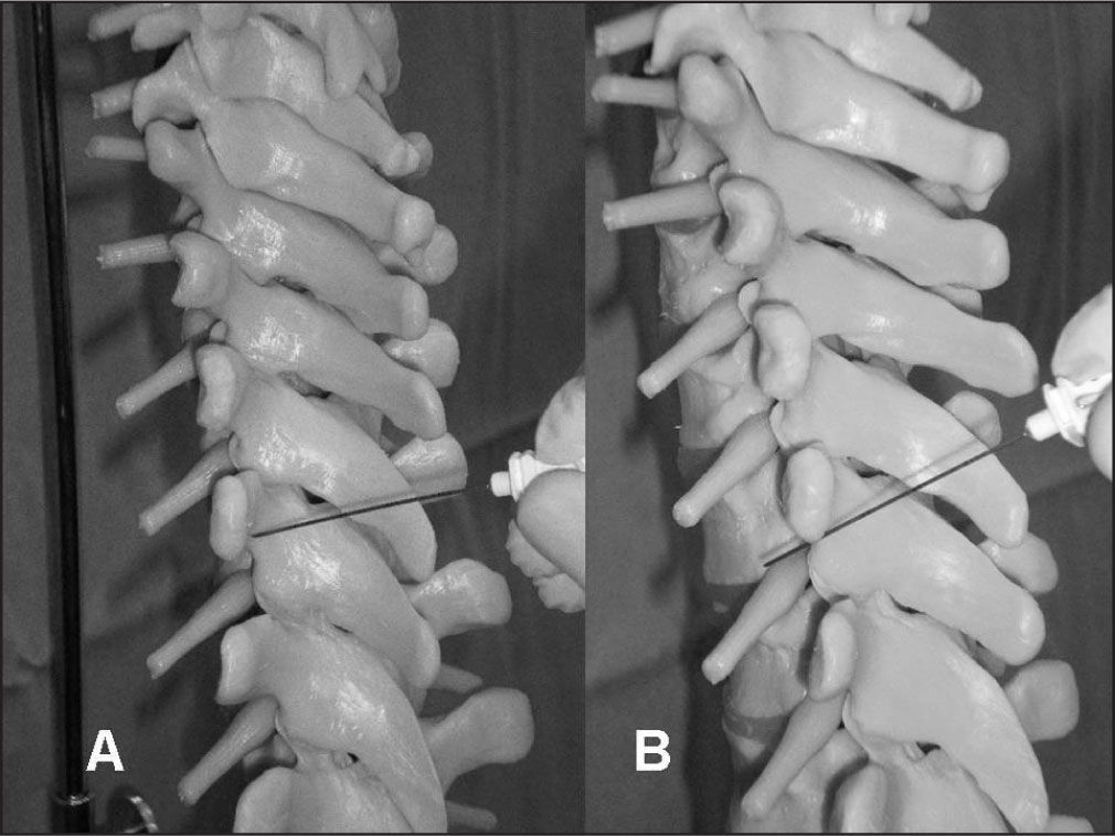 Bloqueo paravertebral torácico con punción múltiple en cirugía ...