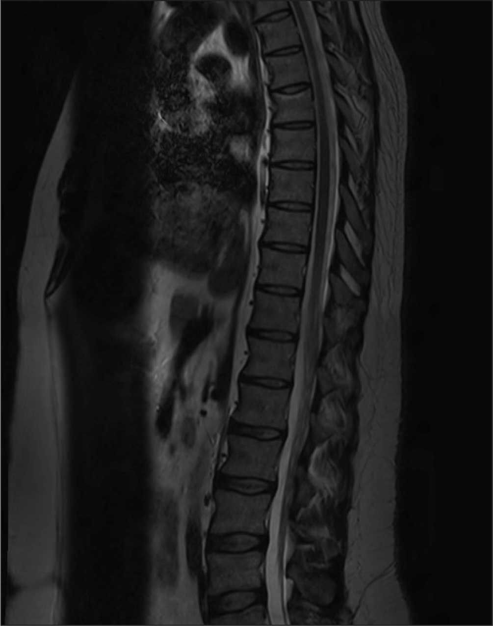 Doble parche hemático epidural como tratamiento de un síndrome de ...