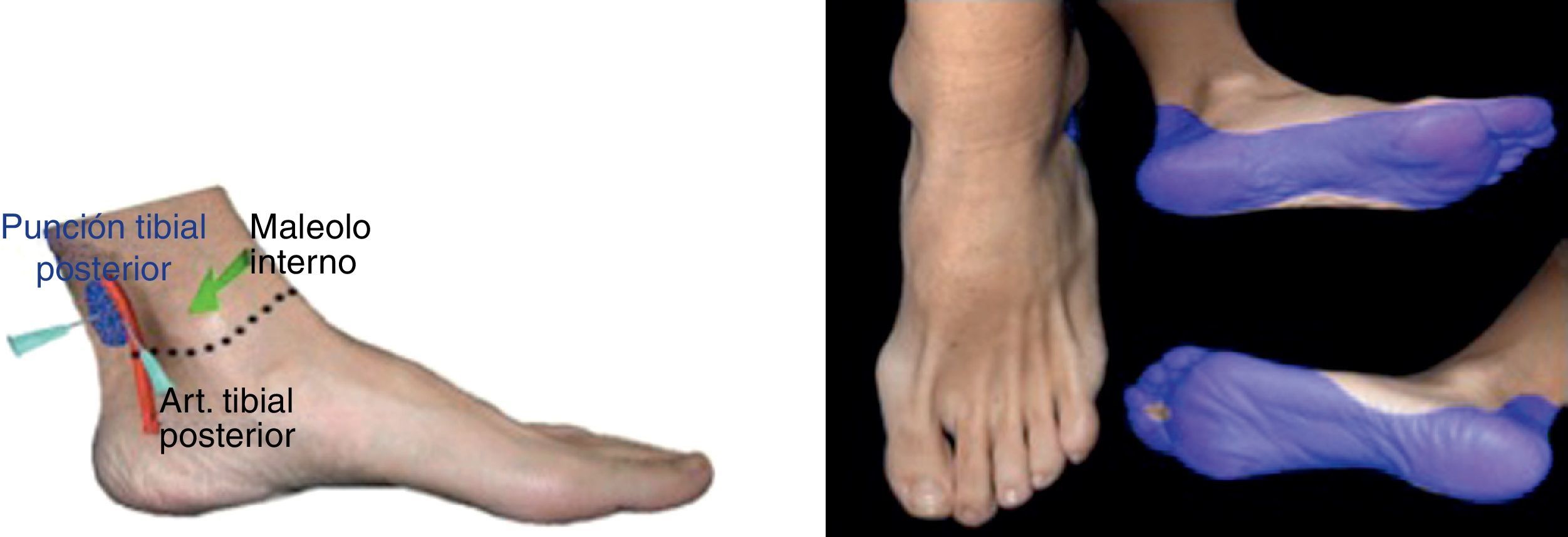 Comparación de la eficacia analgésica postoperatoria del bloqueo de los ...