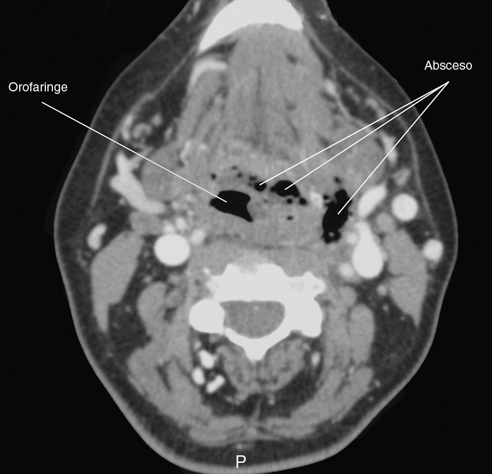 Intubación difícil con Airtraq® y fibrobroncoscopio en paciente ...