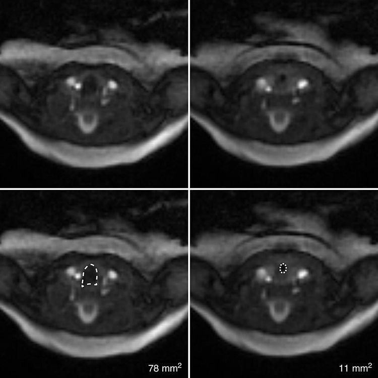 Diagnóstico de traqueomalacia con resonancia magnética nuclear ...