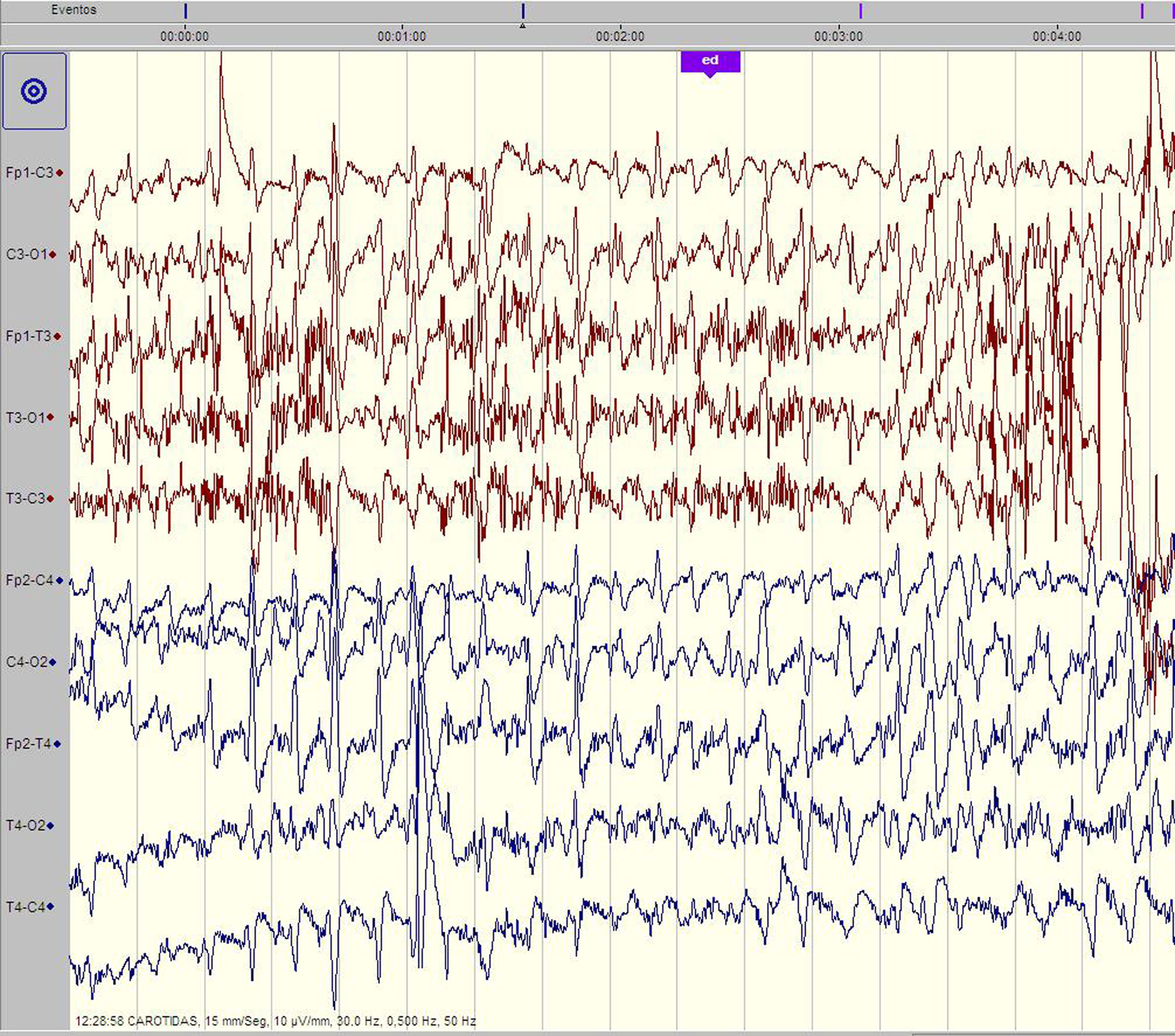 Severe cefepime-induced status epilepticus treated with haemofiltration ...