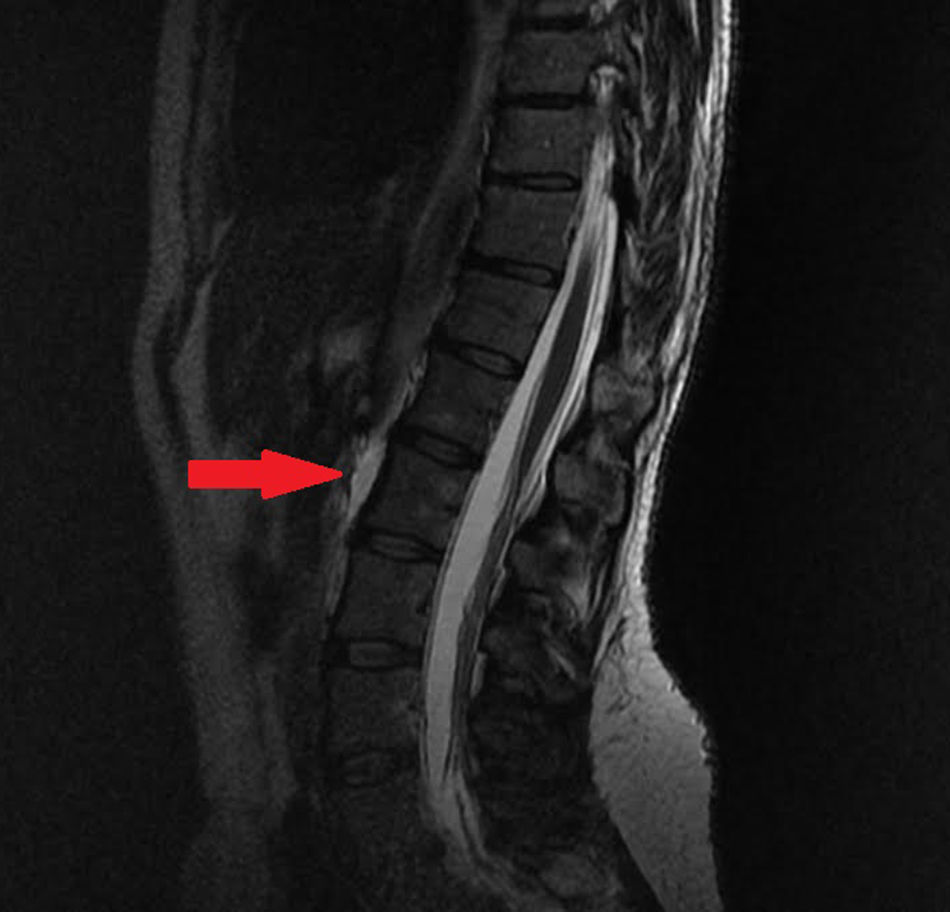 Parche hemático como tratamiento de cefalea por hipotensión de líquido ...