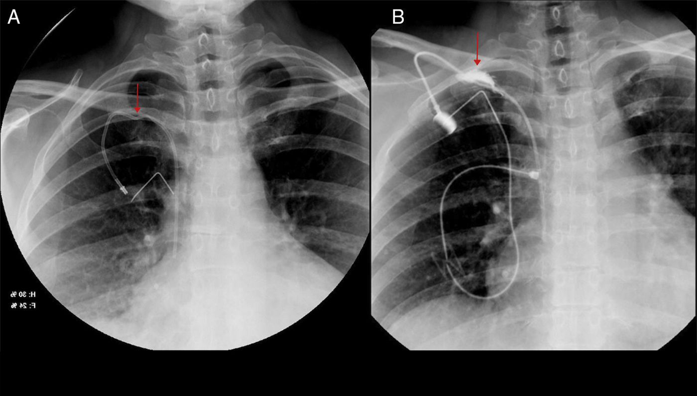 Rotura parcial de Port-a-Cath® en síndrome de «pinch-off» de bajo grado ...