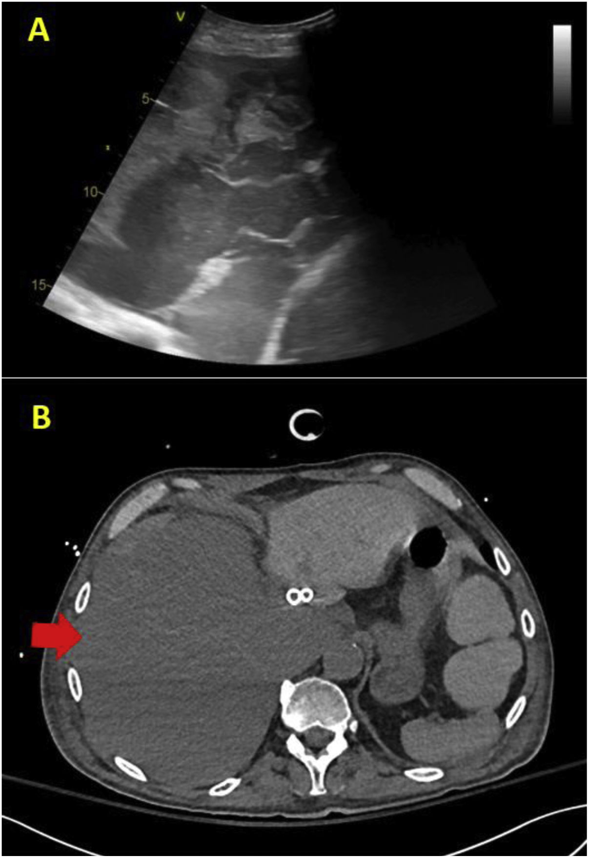 Hemotórax masivo diagnosticado por ecografía en paciente en ECMO ...