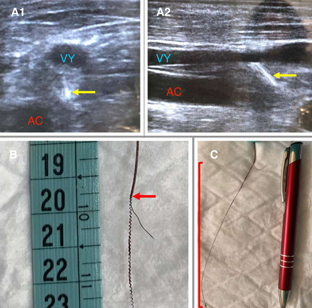 Técnica de Seldinger: si hay resistencia, más vale maña que fuerza ...
