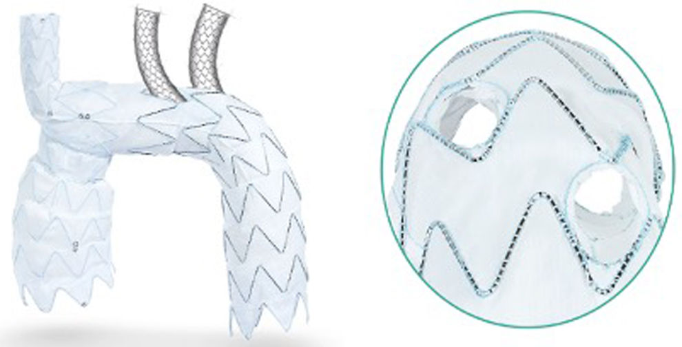 Manejo anestésico de la reparación endovascular del arco aórtico con la ...