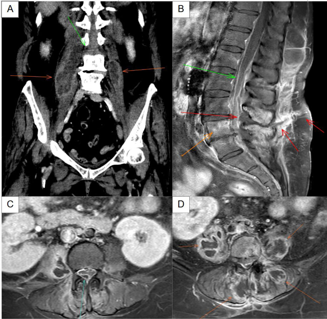 Absceso de psoas bilateral tras técnica neuroaxial | Revista Española ...