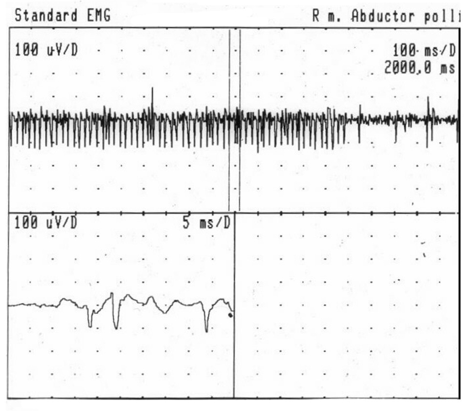 Electromiografía clínica | Rehabilitación