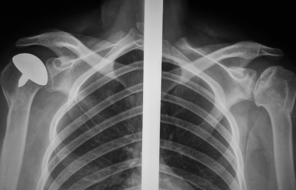 Artroplastia de recubrimiento de cabeza humeral en paciente joven con ...