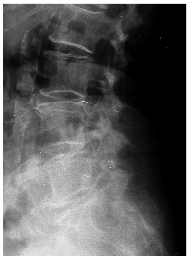 Artrosis interespinosa (síndrome de Baastrup): presentación de un caso ...