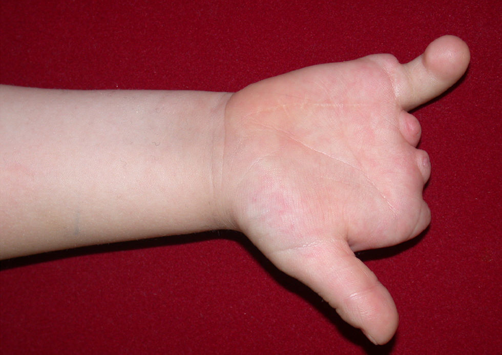 Resultados funcionales de la simbraquidactilia tratada quirúrgicamente ...