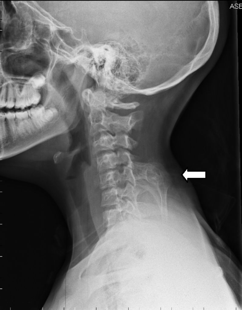 Deformidad de Sprengel con hueso omovertebral asociado | Rehabilitación
