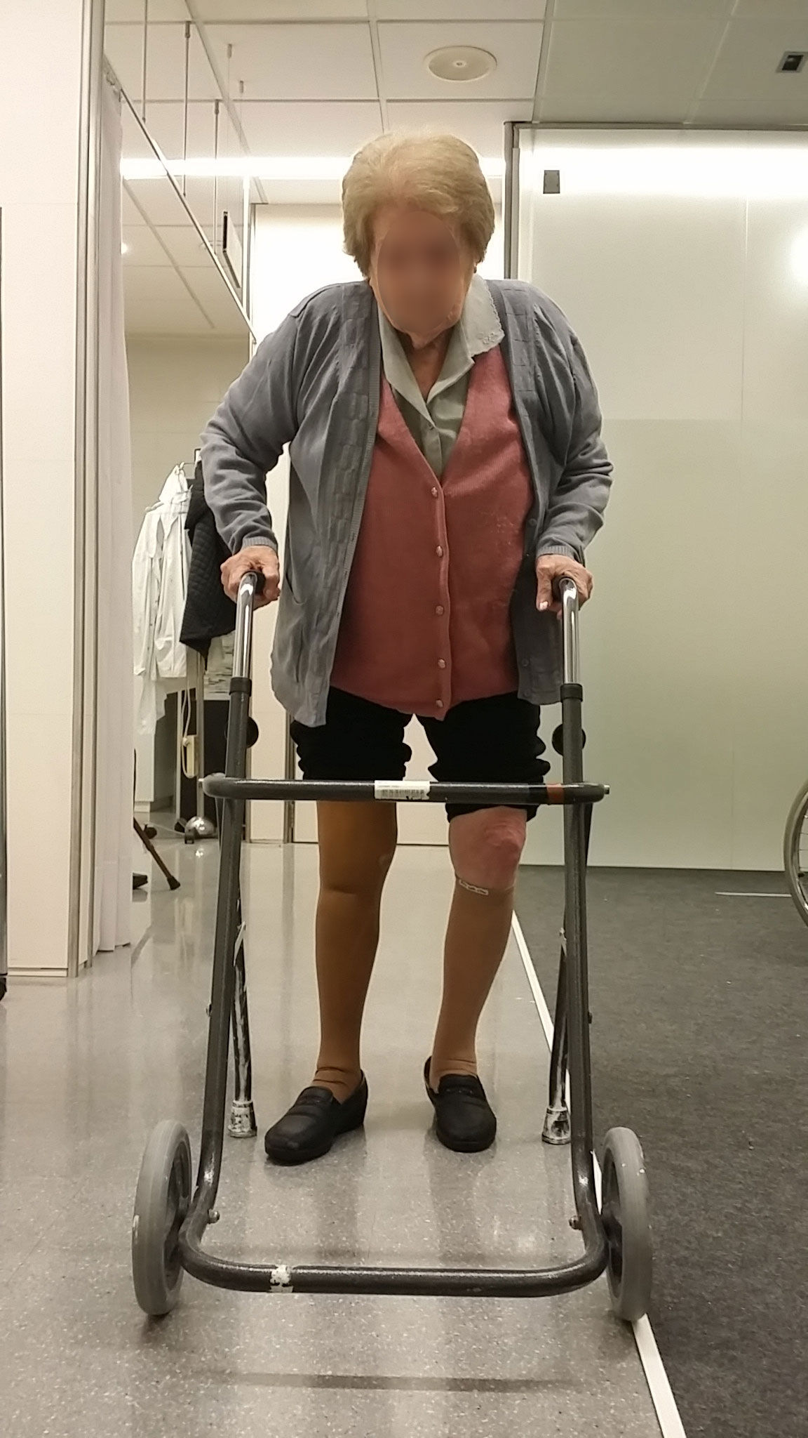 Revisión de la amputación Gritti-Stokes, a propósito de un caso ...