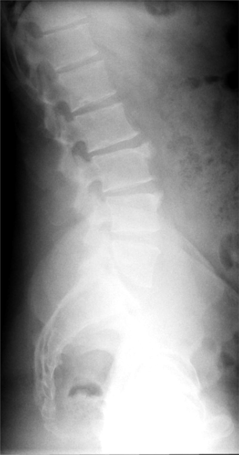 Vértebra limbus múltiple: ¿un hallazgo radiológico inespecífico o causa determinante de dolor ...