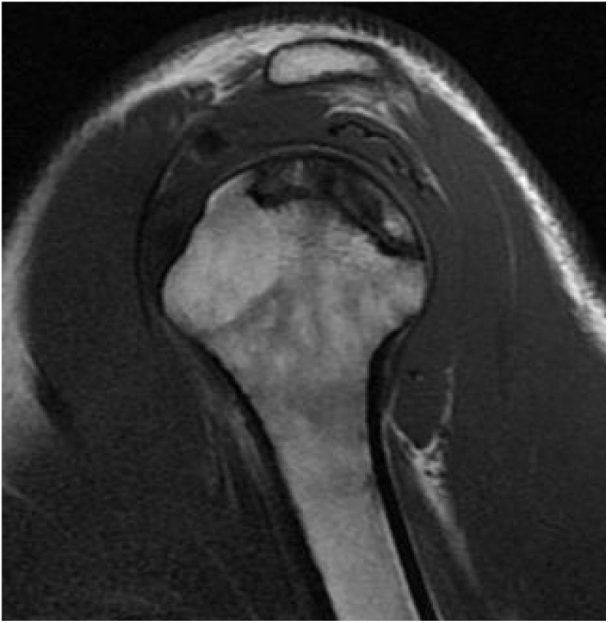 Osteonecrosis multifocal. Actualización y caso clínico | Rehabilitación