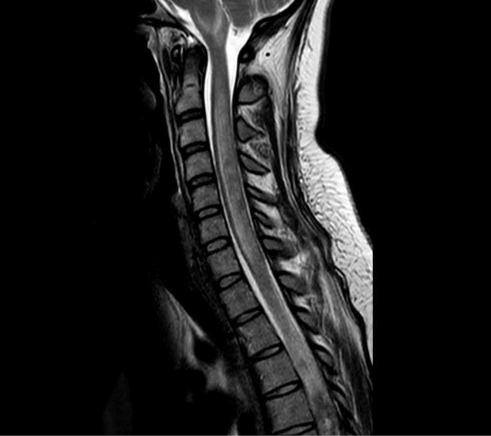 Mielitis transversa hemorrágica longitudinalmente extensa secundaria a ...