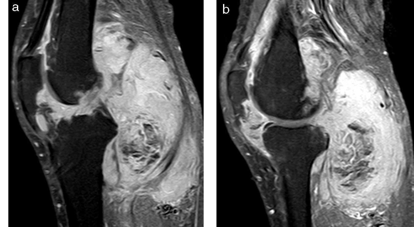 Caracterización imagenológica de la sinovitis vellonodular pigmentada y ...