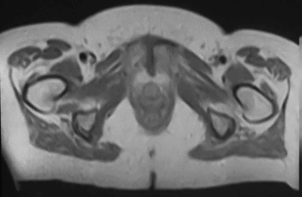 Artritis séptica de la sínfisis del pubis | Revista Argentina de Radiología
