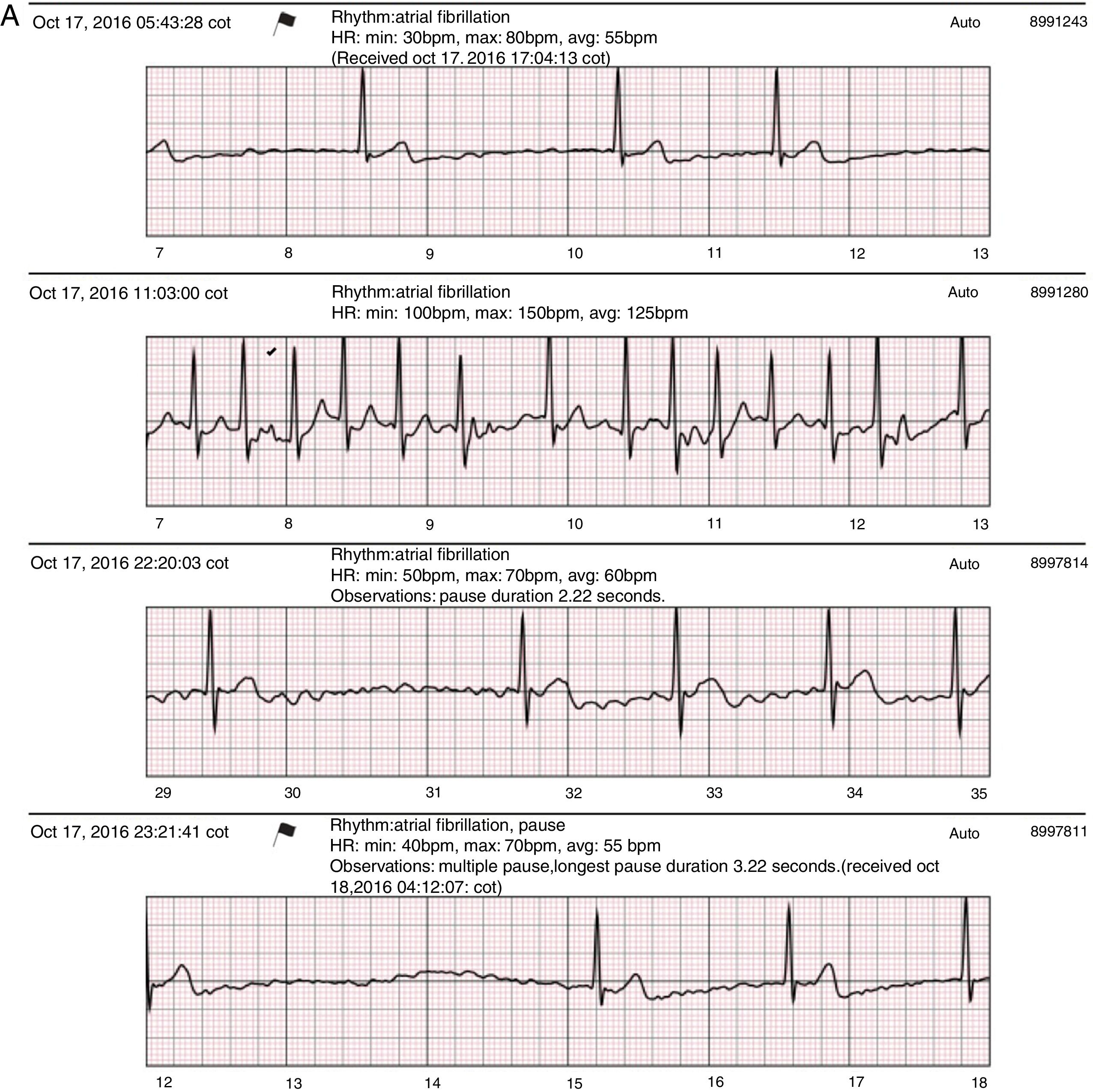Clinical experience in extended cardiac monitoring with the SEEQ ...