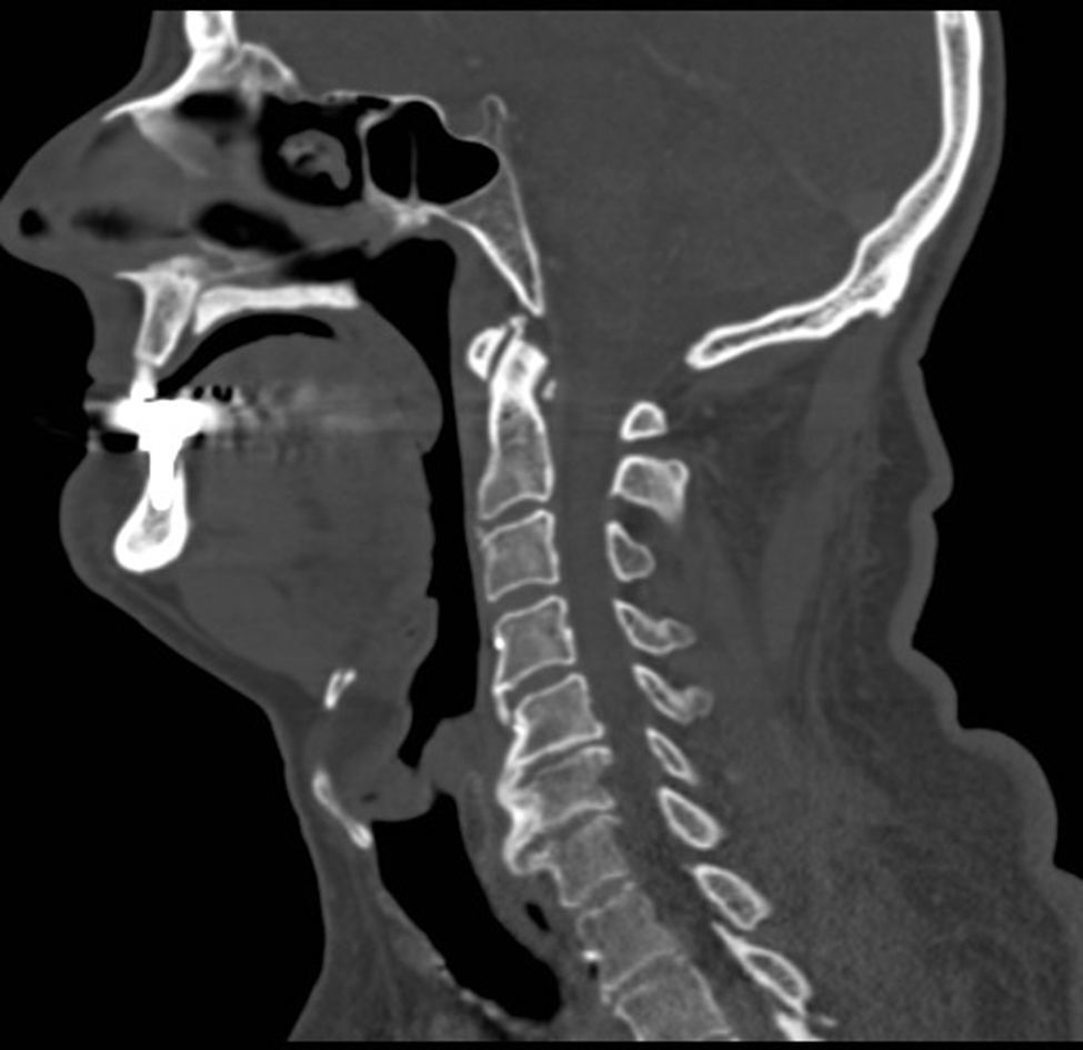 Enfermedad de Forestier y absceso cervical | Revista Colombiana de ...