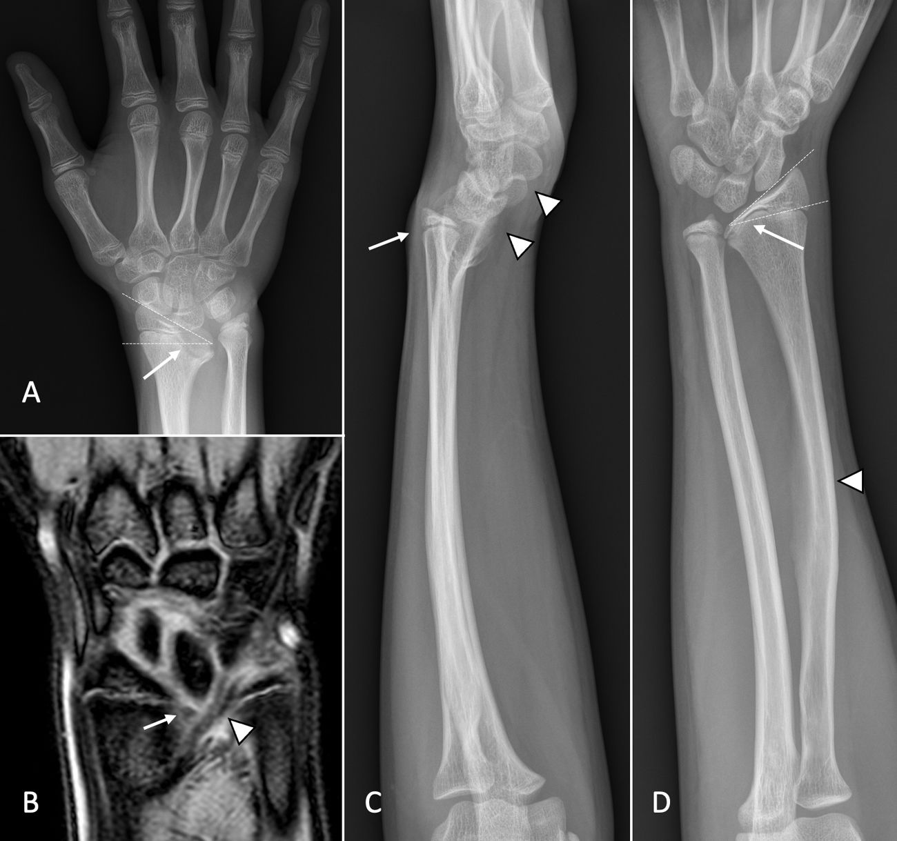 Deformidad de Madelung en un niño con discondrosteosis de Léri-Weill ...
