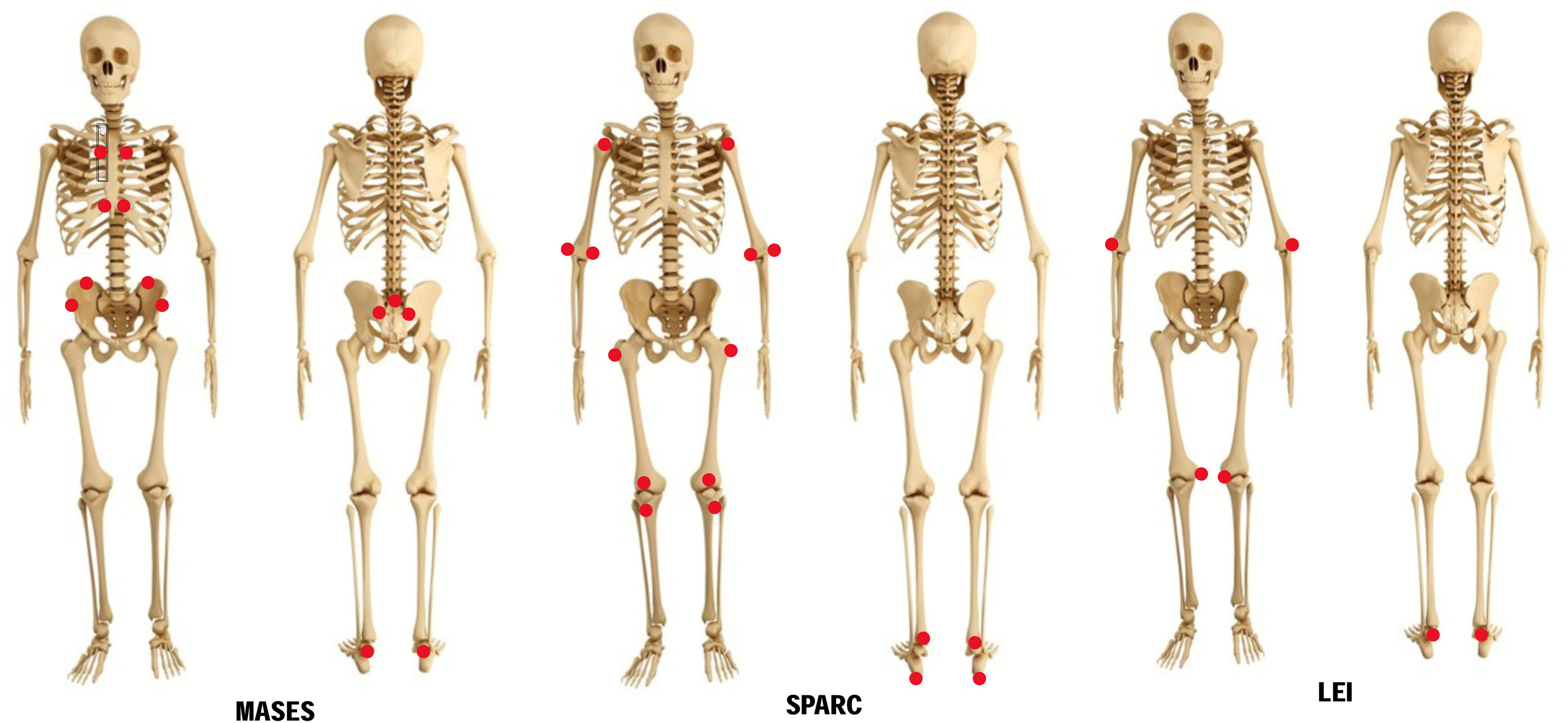 Assessment tools in psoriatic arthritis: A review | Revista Colombiana ...