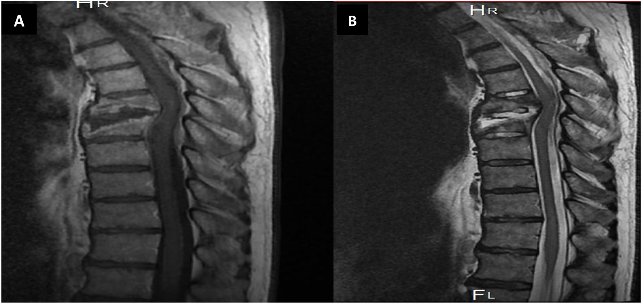 Infectious spondylodiscitis: When a rare infection is associated with ...
