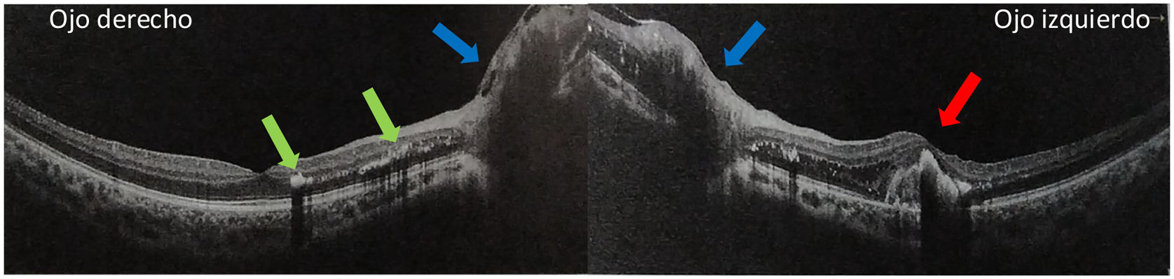 Vasculitis retinal idiopática, aneurismas y neurorretinitis (IRVAN ...