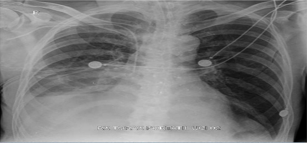 Lesión cardiaca en paciente con sepsis pulmonar secundaria a E. coli ...