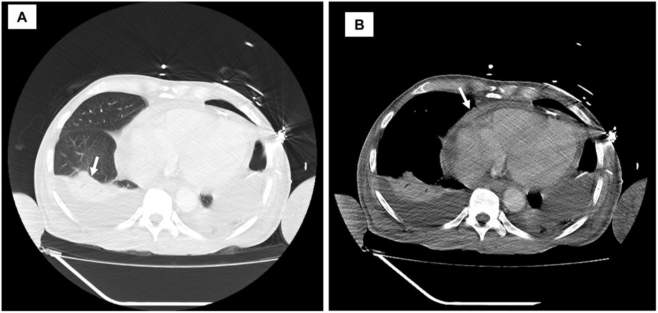 Pericarditis purulenta por Staphylococcus aureus resistente a ...