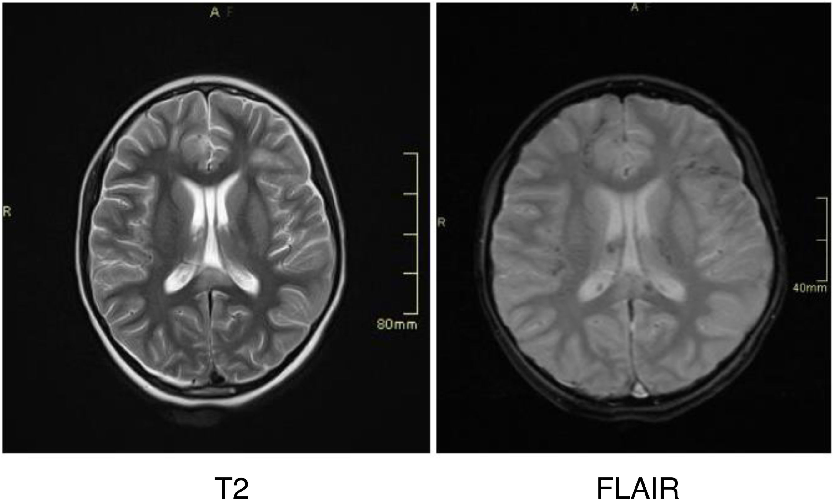 Daño axonal difuso posterior al trauma craneoencefálico en pediatría ...