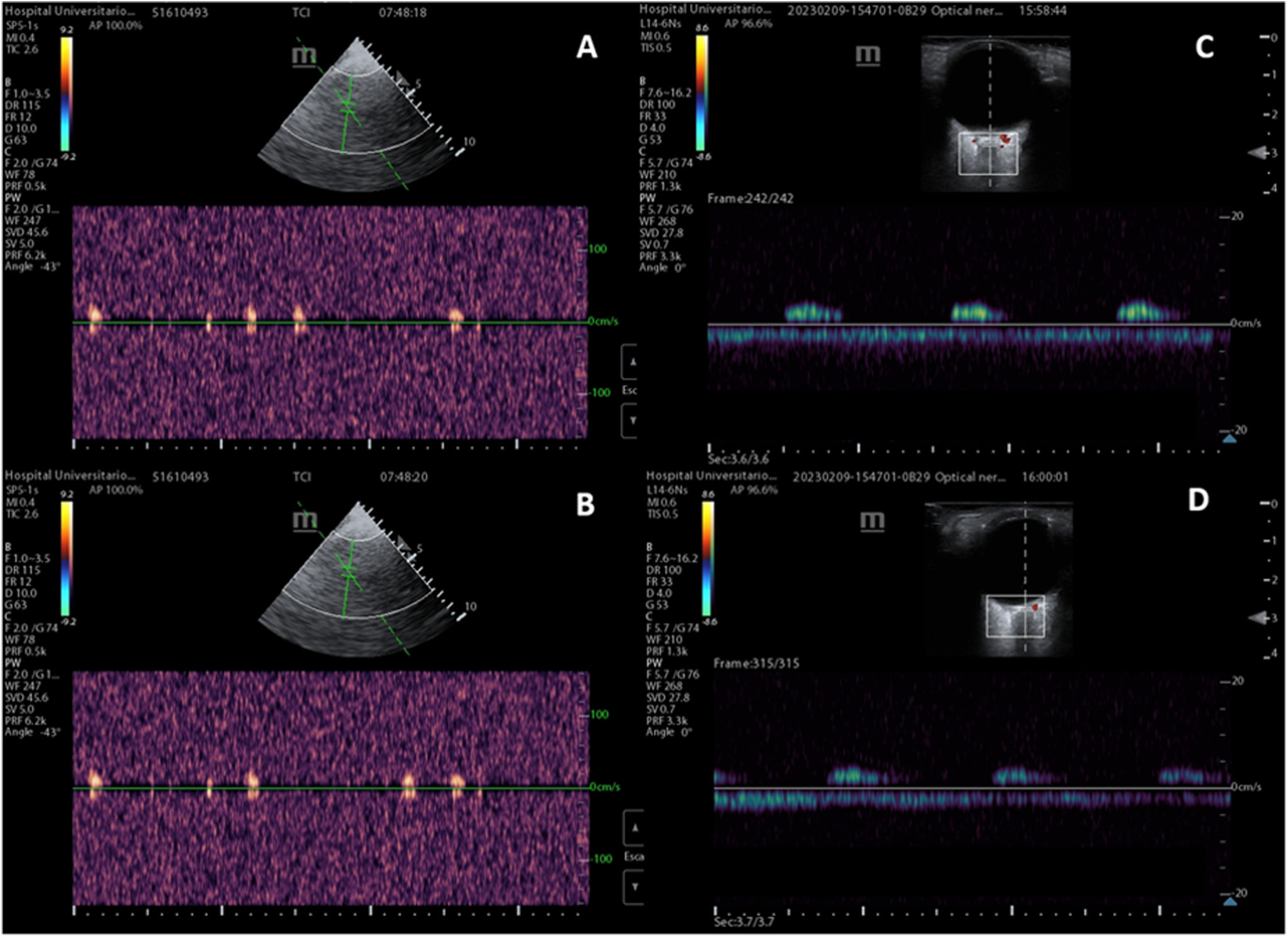 Central retinal vessels Doppler assessment of brain death as an ...