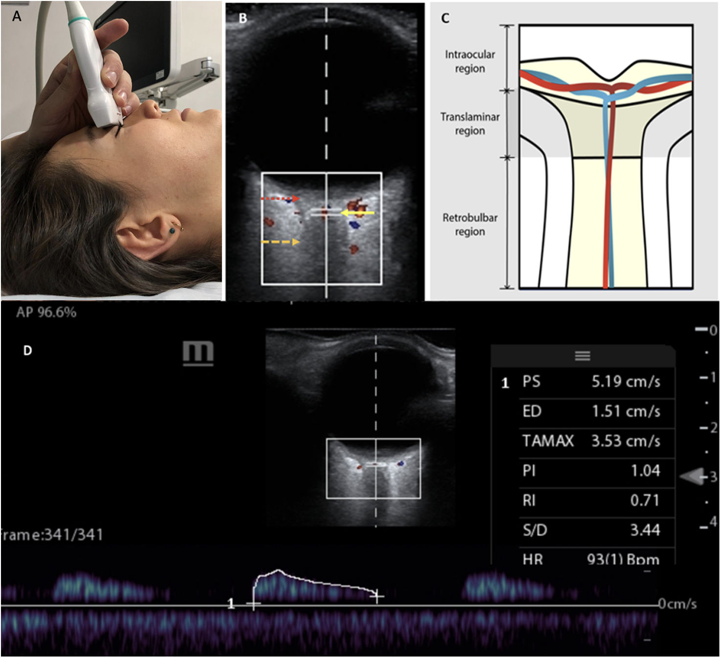 Central retinal vessels Doppler assessment of brain death as an ...