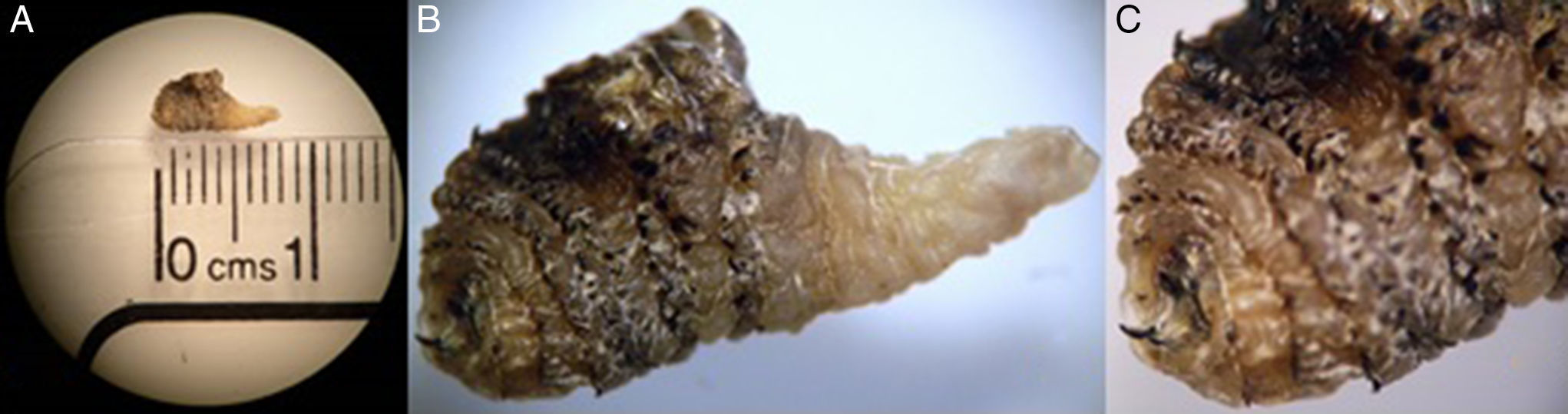 Furuncular myiasis—Eco-epidemiological view of a case report | Infectio