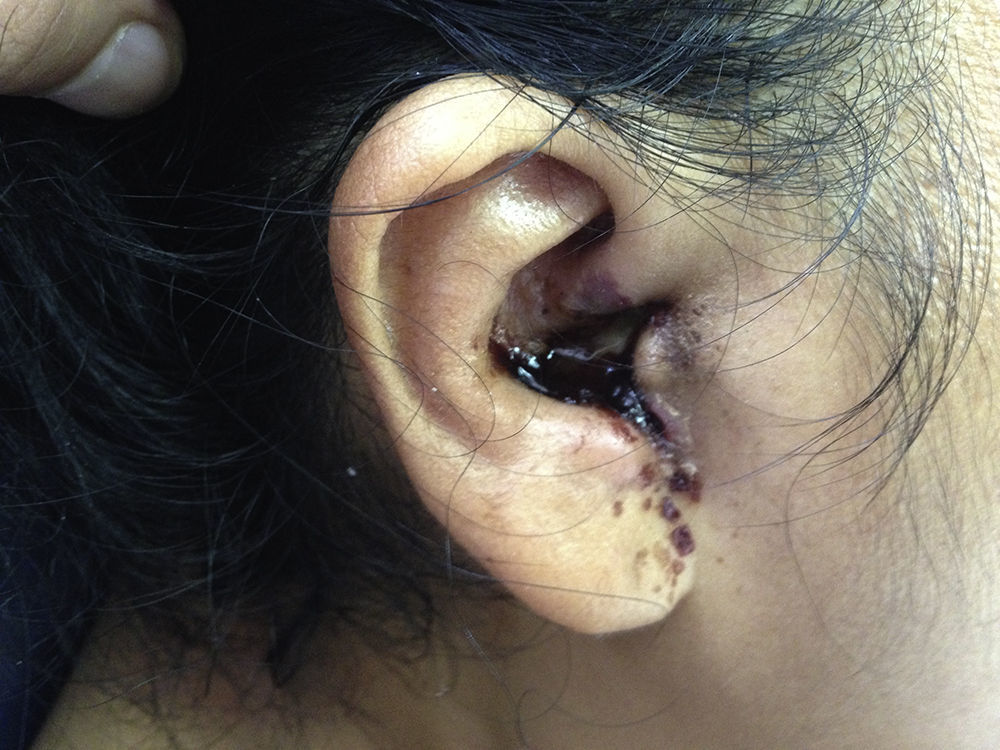 otitis externa maligna