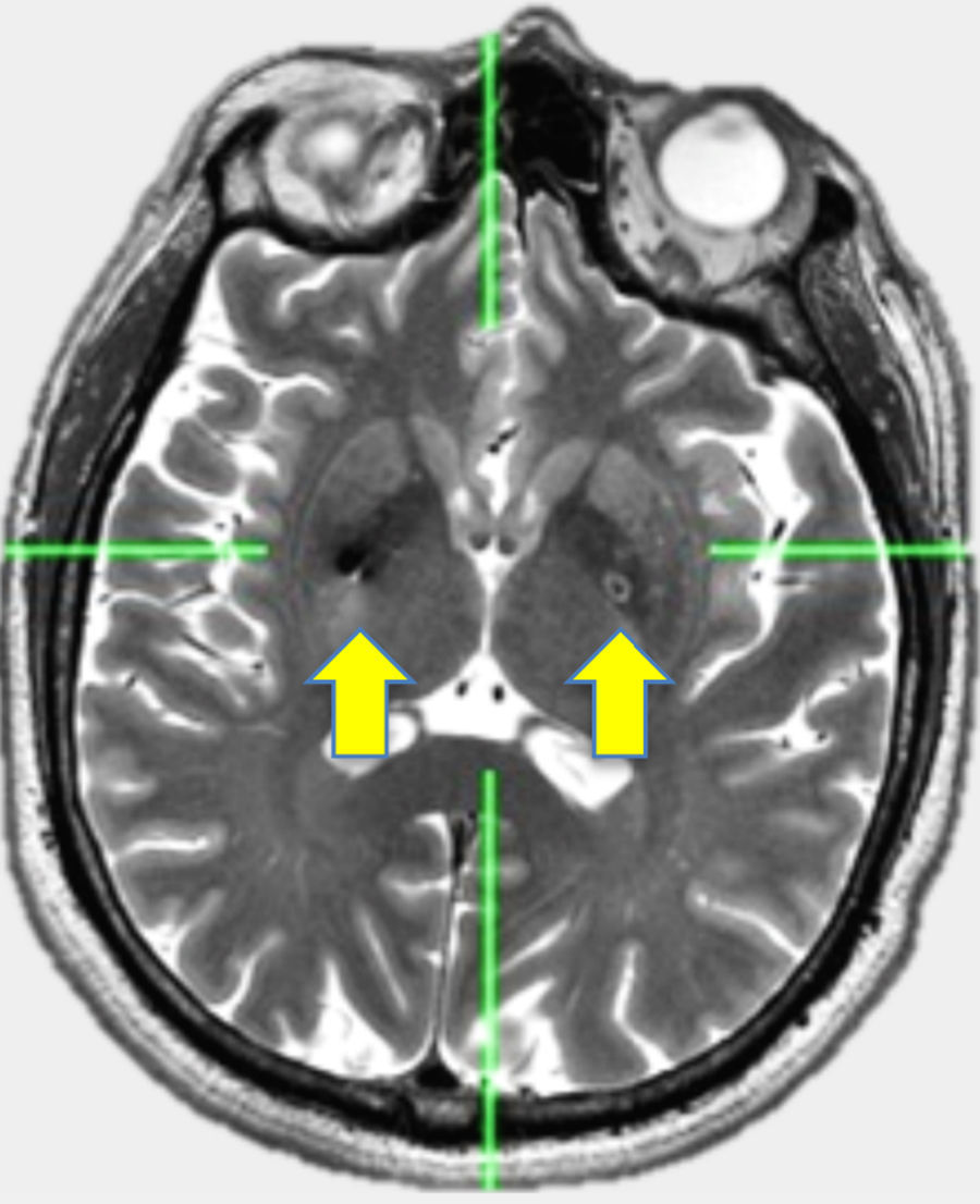 subthalamic nucleus coronal mri