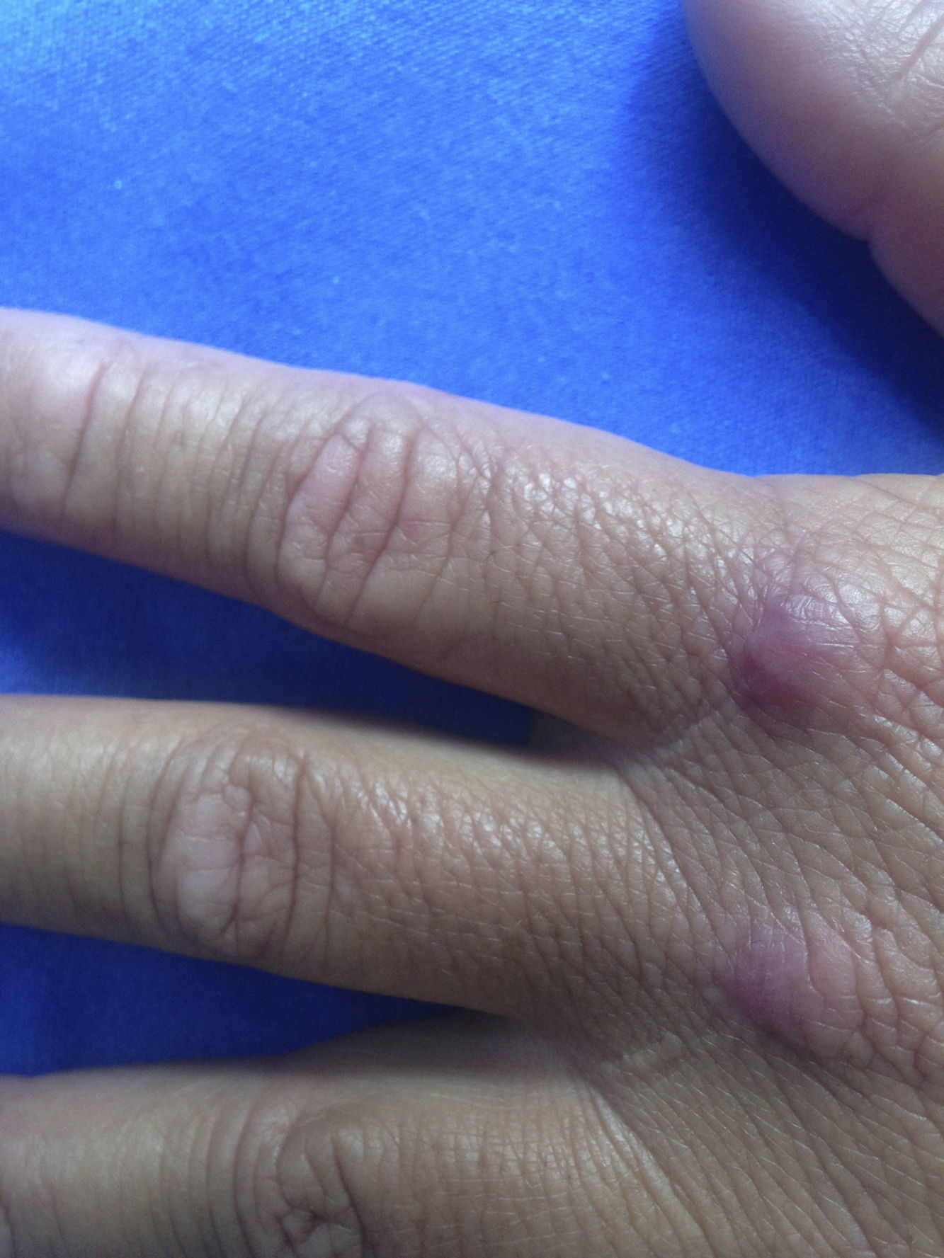 Adult colloid milium. An underdiagnosed and difficult to treat entity ...