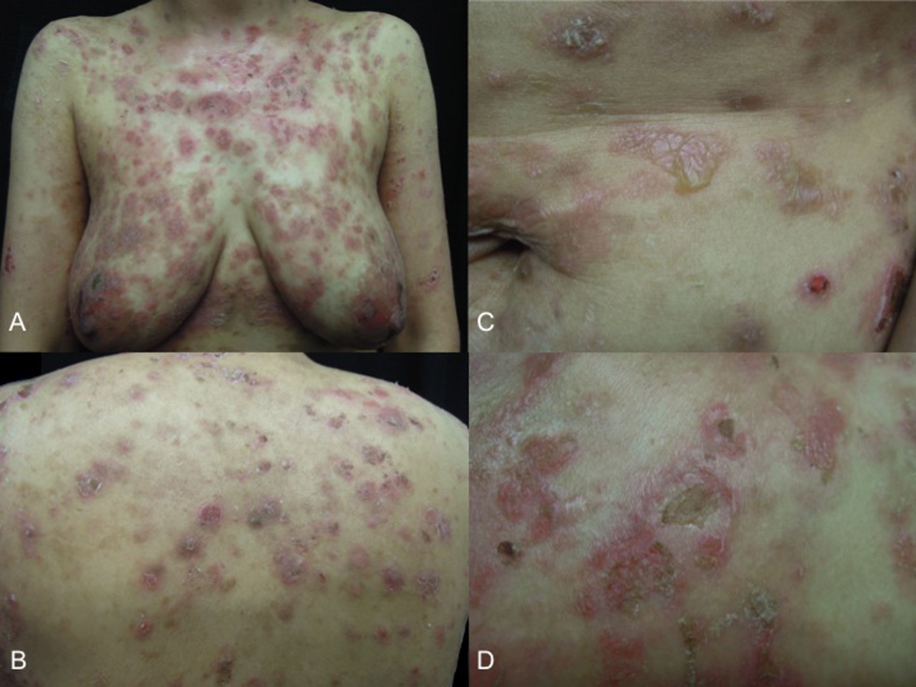 vesicular pemphigoid