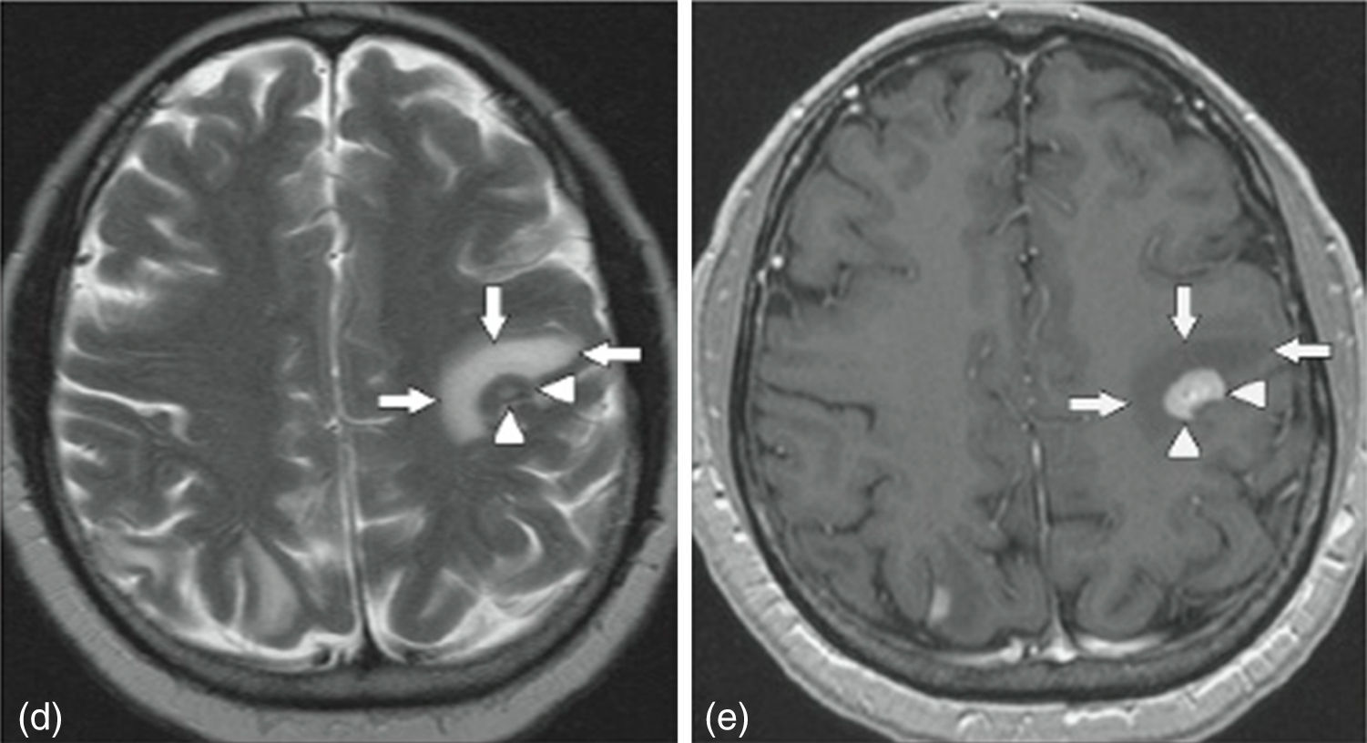 Brain metastases: Literature review | Revista Médica del Hospital ...