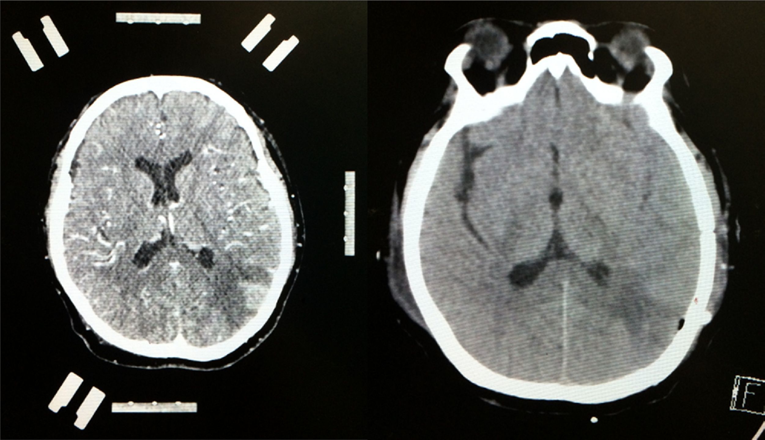 Left temporal cerebral syphilitic gumma: Case report and literature ...