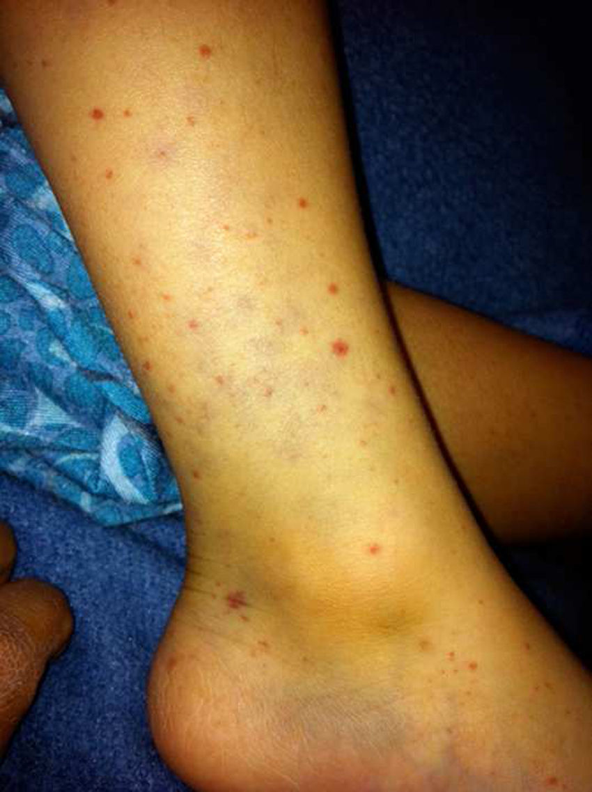 does cmv cause a rash