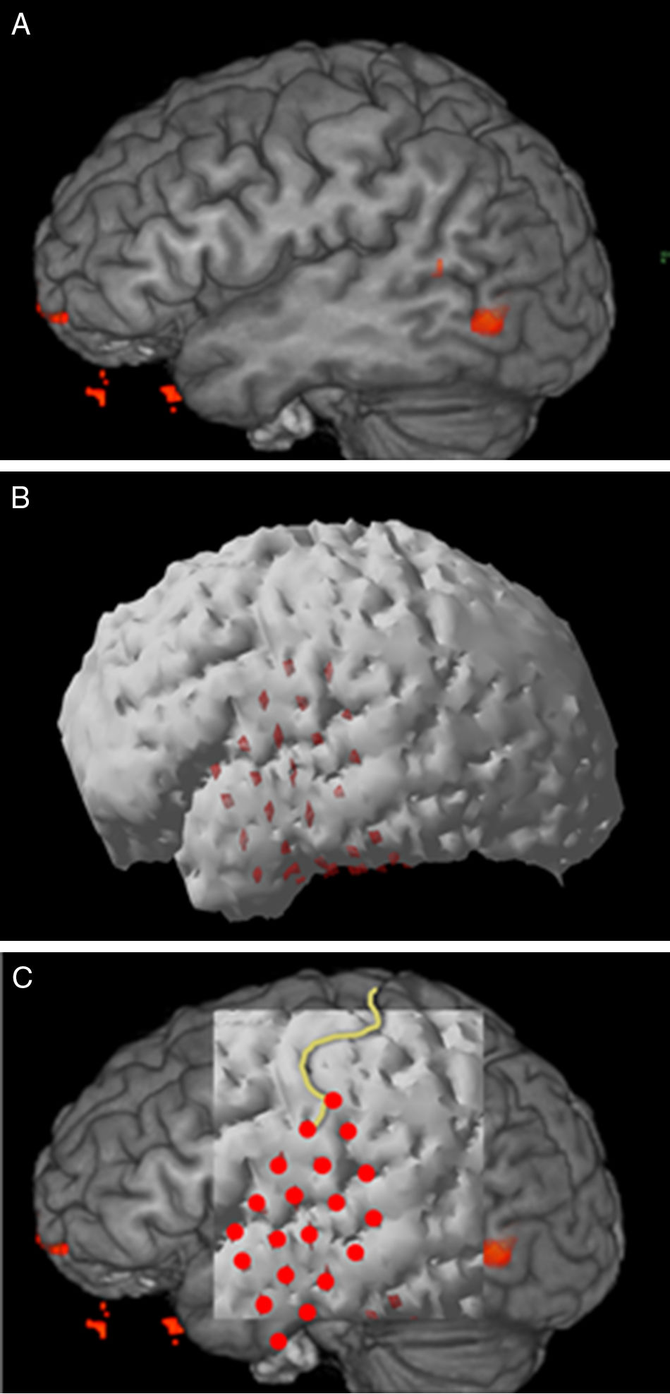 Functional magnetic resonance for the localization of eloquent areas in ...