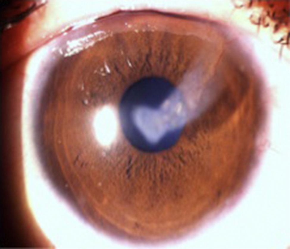 Blefaroqueratoconjuntivitis estafilocócica en la edad pediátrica ...