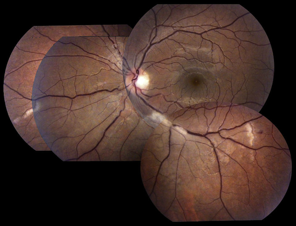 Asa vascular prepapilar con oclusión de rama arterial | Revista ...