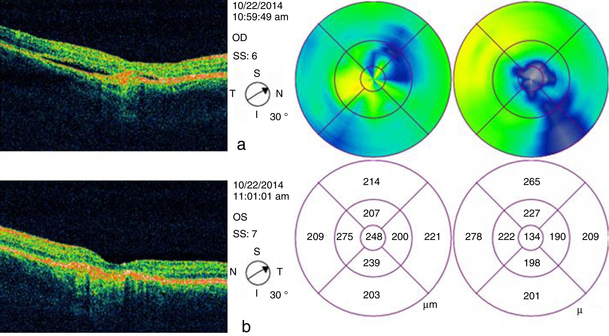 Enfermedad de Best o distrofia macular viteliforme. A propósito de un ...