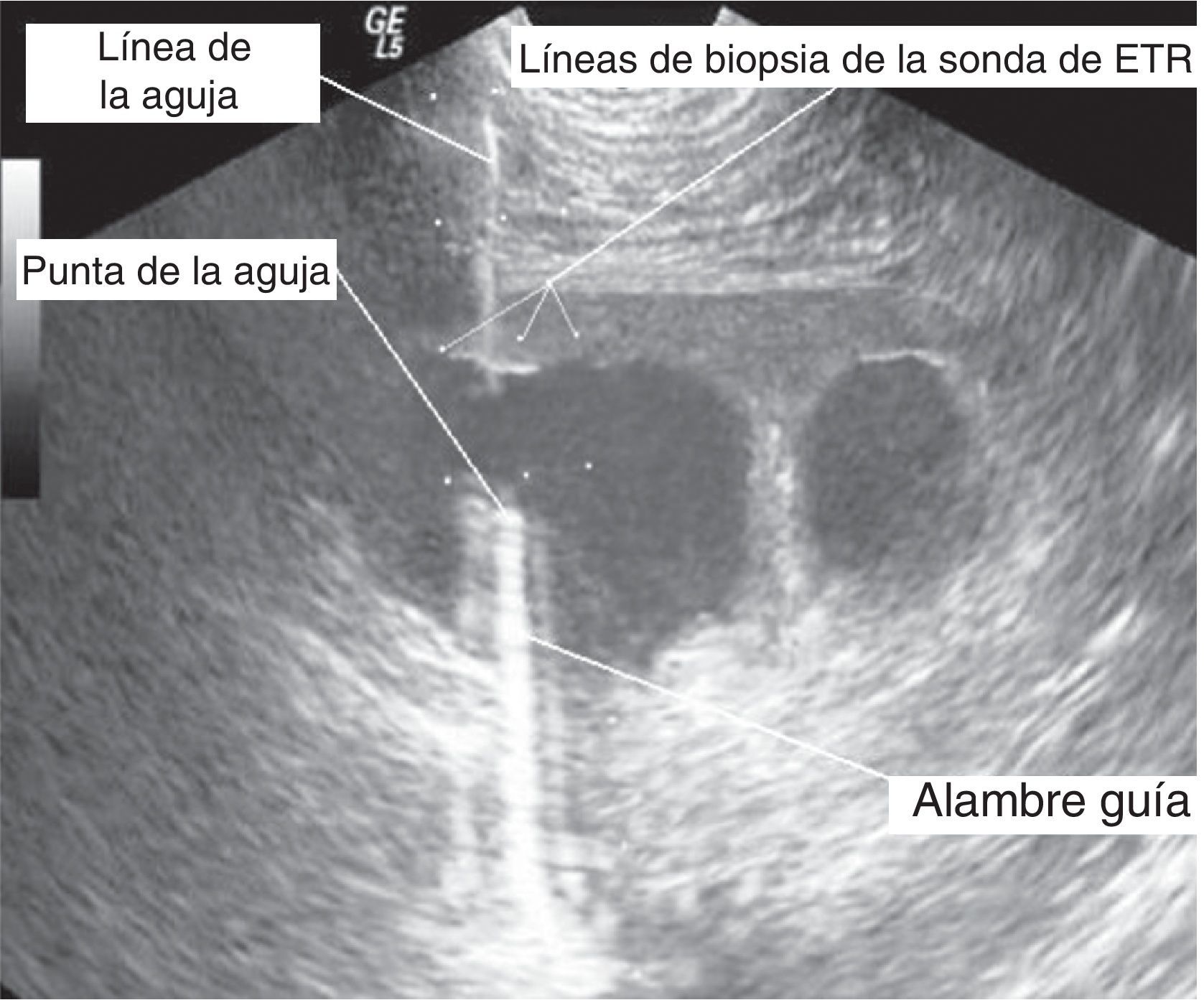 Un abordaje diferente a la nefrostomía percutánea por urólogos | Actas ...