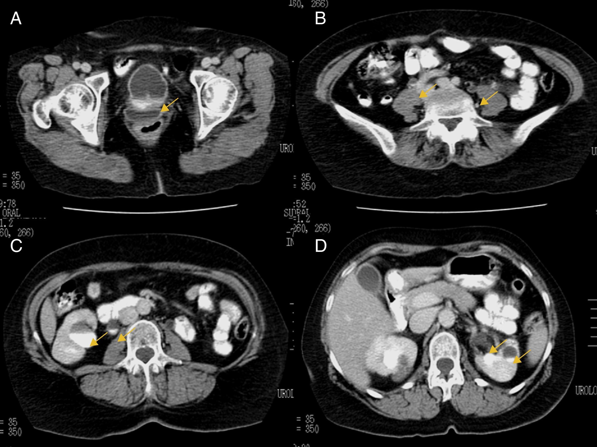 Cistectomía radical, histerectomía con doble anexectomía y ...