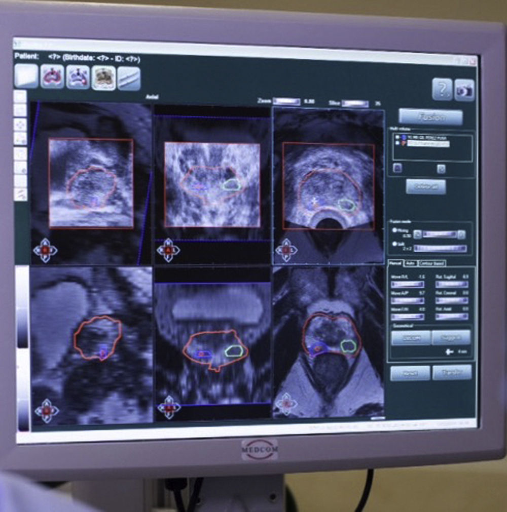 Biopsia prostática transperineal con fusión de imagen ecografía ...