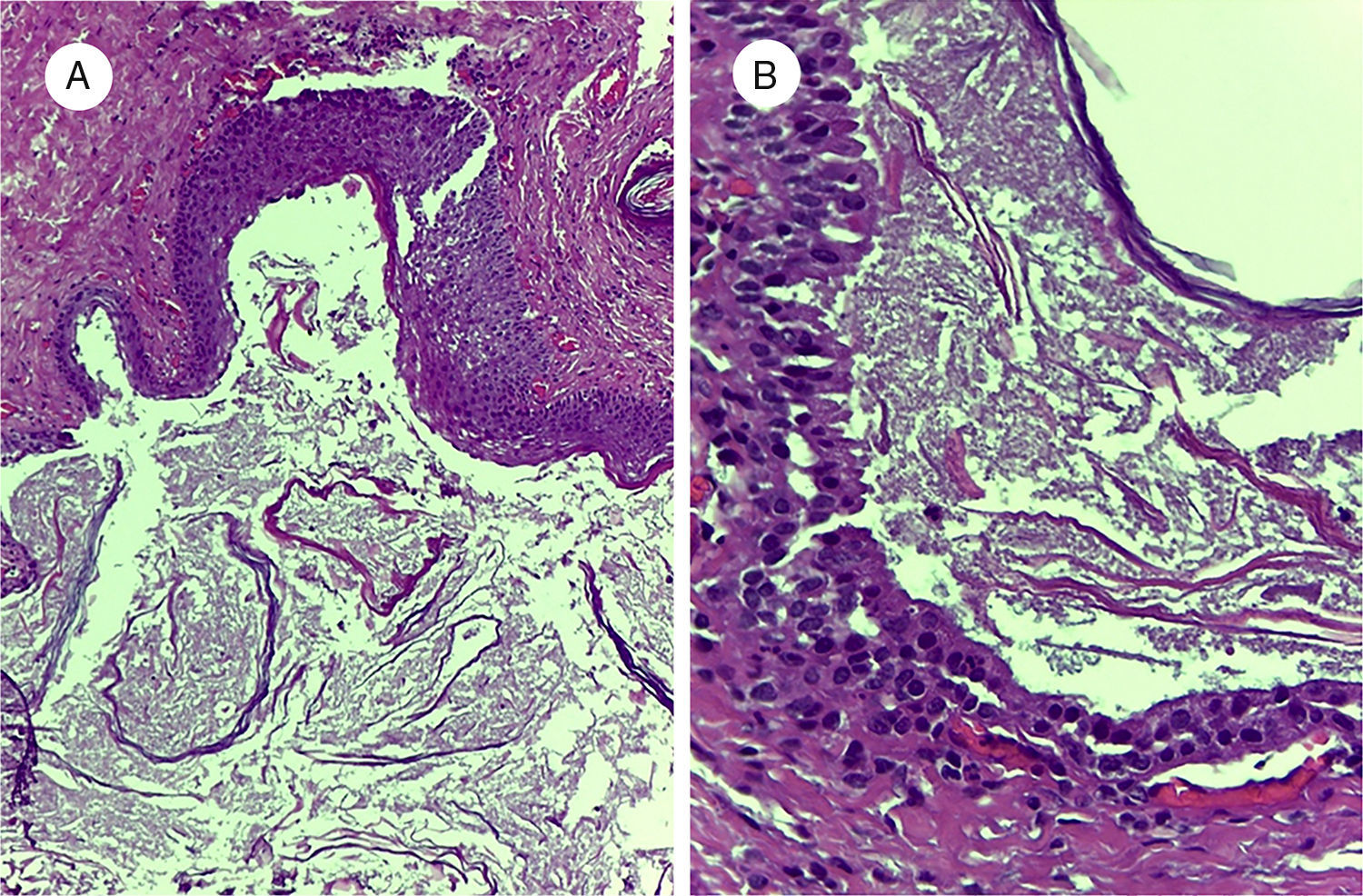 Quistes de rafe medio en el varón. Presentación de nuestra experiencia ...